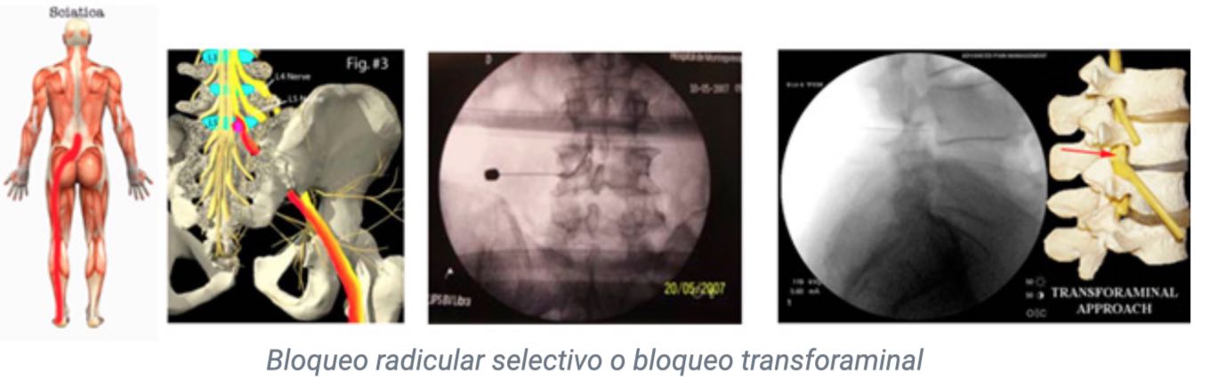 Bloqueo Radicular Selectivo o Bloqueo Transforaminal – Madrid sin dolor